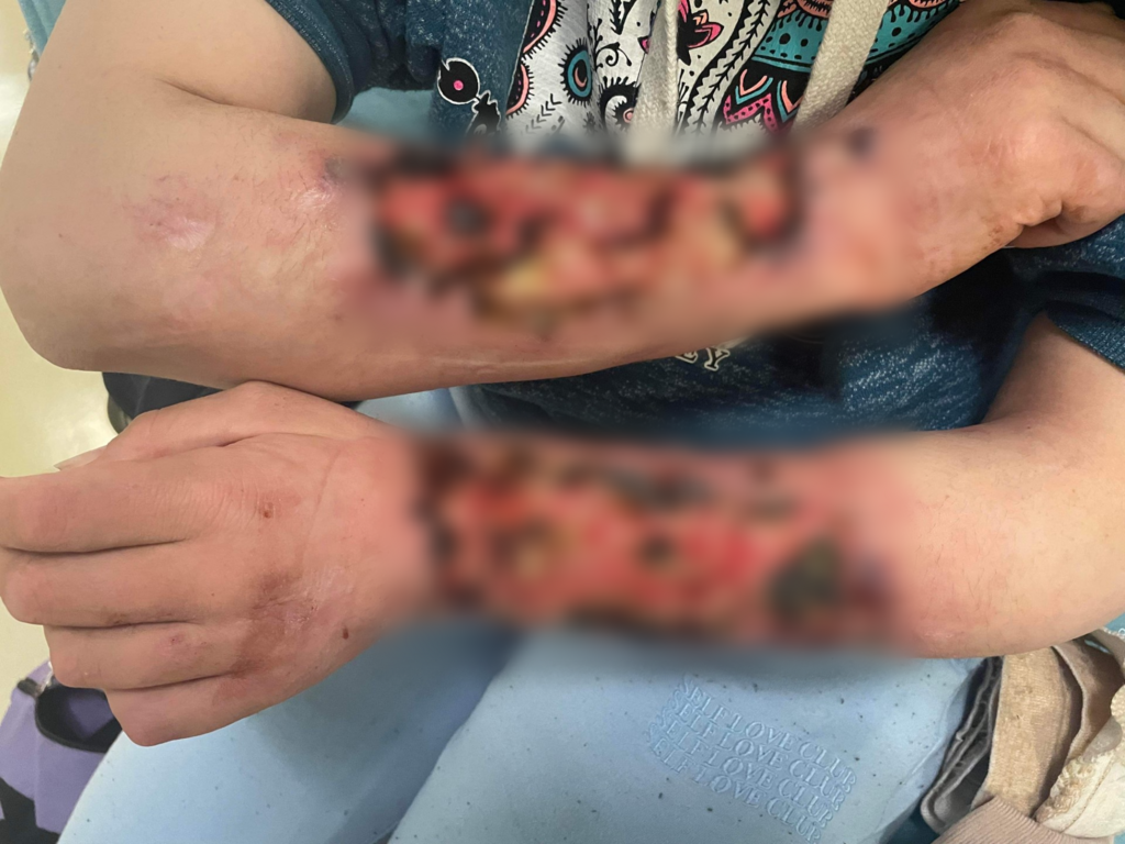 In Philadelphia, skin-rotting drug ‘tranq’ invades a neighbourhood ...