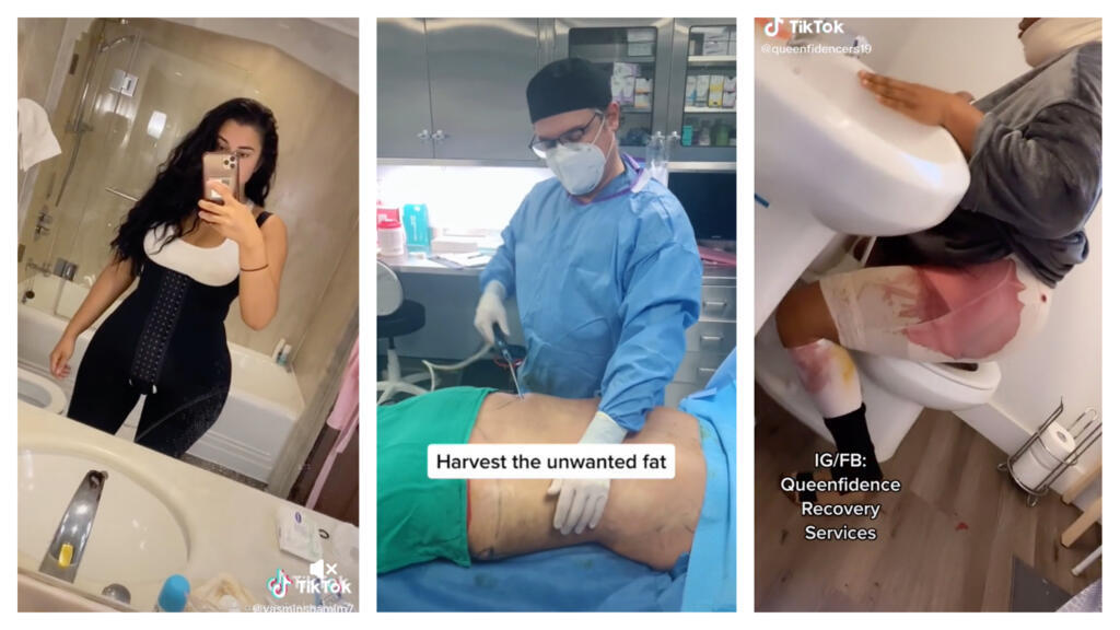 The BBL surgery 'that only the Kardashians could have' becomes ...